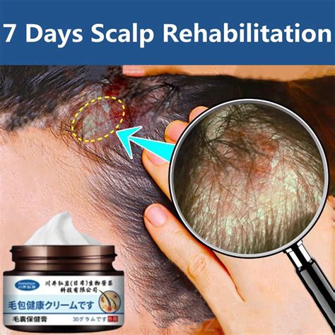 Seborrheic Dermatitis Cream Scalp Treatment Psoriasis Folliculitis Scalp Tinea Dandruff