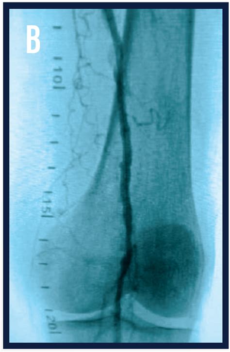 Extending Expectations For Long Sfa Lesions Endovascular Today