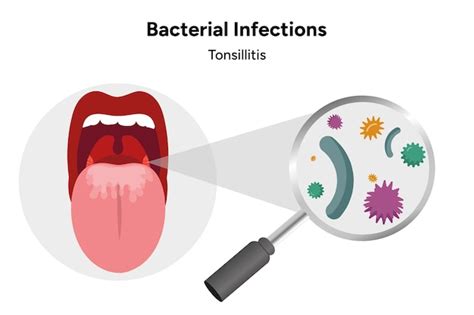 박테리아 감염 톤실리티스 프리미엄 벡터