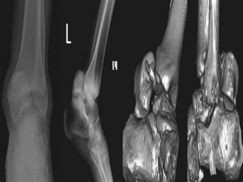 Three Dimensional Tomographic Images Showing Fracture Dislocation Of