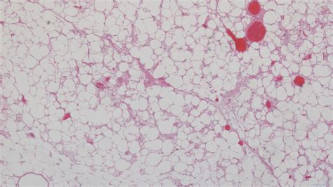 Hibernoma Atlas Of Pathology