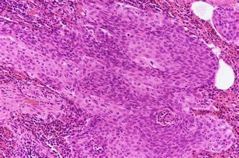 Squamous Cell Carcinoma Lung Keratin Pearls H E Stained Section Shows