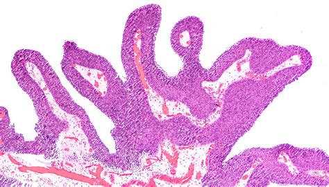 High Grade Bcg Unresponsive Bladder Cancer Management And Alternatives