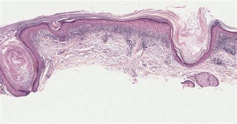 Differential Diagnosis In Dermatopathology Follicular Plugging