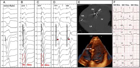 Pacing Electrocardiogram Characteristics And The Location Of The Pacing