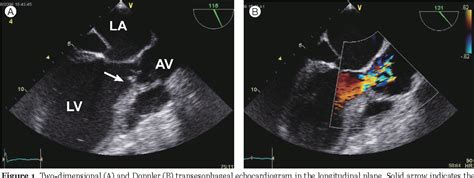 Figure 1 From Subaortic Membrane Late After Surgical Correction Of Tetralogy Of Fallot