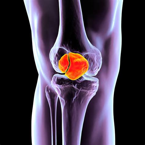 Bipartite Patella A Condition Where The Kneecap Has An Unfused Accessory Ossification Center