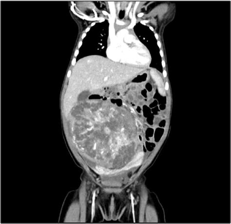 Ct Abdomen And Pelvis Sagittal View Showing Tumor On The Right Side