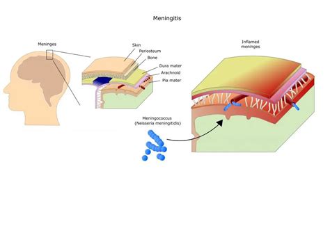 Aseptic Meningitis Causes Symptoms Diagnosis Treatment Remedies