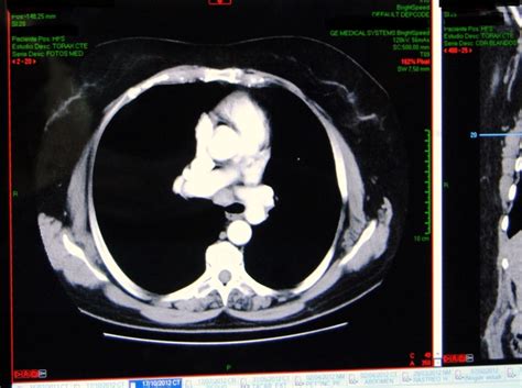 Case Report Hilar Mass Resection Using Single Port Thoracoscopy With Dr Diego Gonzalez Rivas