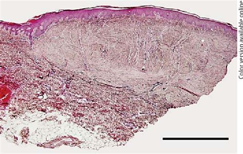 Figure 4 From Nodular Morphea Semantic Scholar