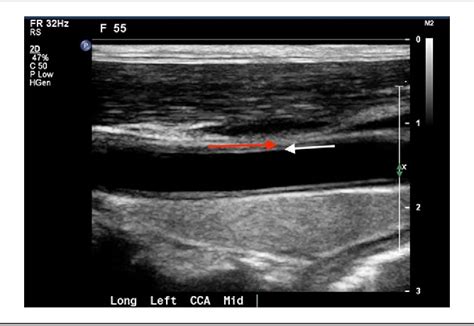 Figure 1 From Carotid Doppler Ultrasound Beyond Stenosis Semantic