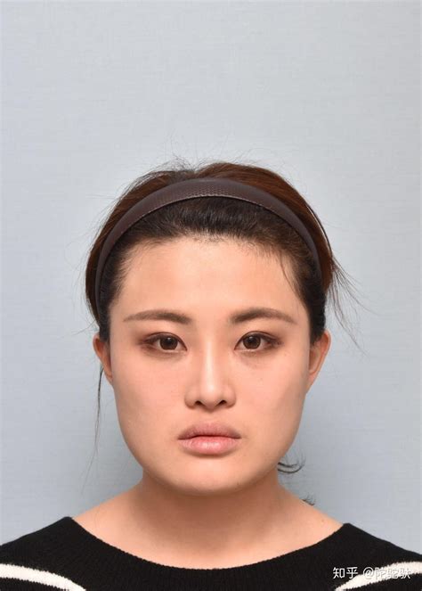 双鄂轮廓手术 术后6个月的后记 知乎