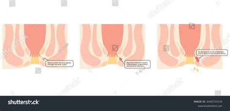 Diseases Anus Hemorrhoids Anorectal Hemorrhoids Illustration Stock