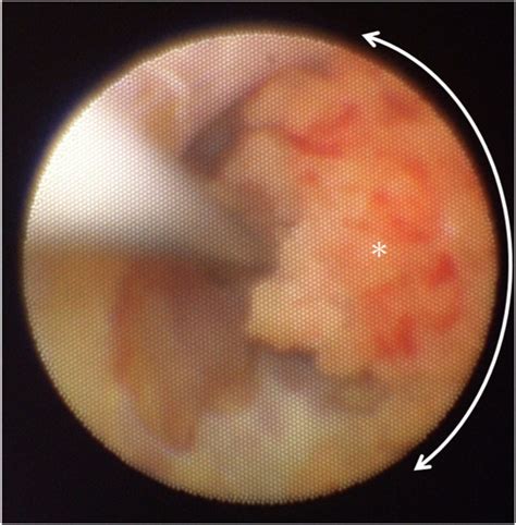 Progression From Nodular Calcification To Calcified Nodules Leading To Acute Myocardial