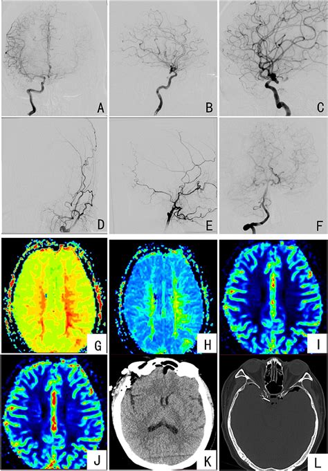 Frontiers Case Report The Different Fates Of Three Aneurysms