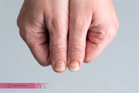 Nail Diseases Chart Picture Sign And Treatment