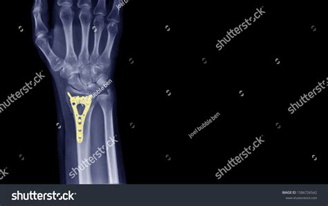 11554 Wrist Fracture 图片、库存照片和矢量图 Shutterstock
