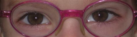 Accommodative Esotropia Pediatric Ophthalmic Consultants