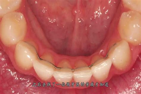 牙齿内侧黄黄的东西，又脏又臭，用这招可以轻松去除！生活健康养生好看视频