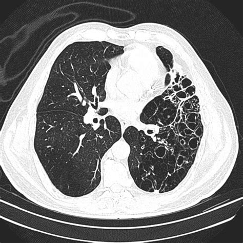 Cystic Bronchiectasis Pacs