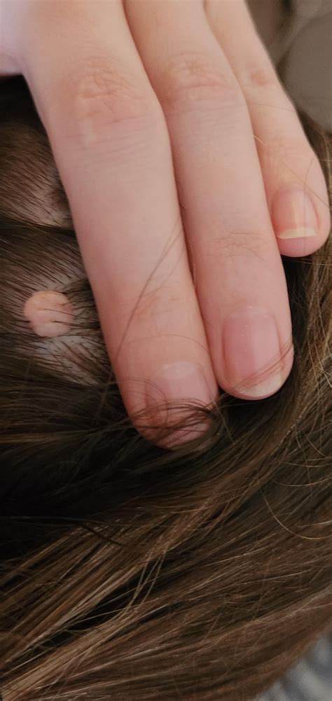 Mole On Scalp R Dermatologyquestions