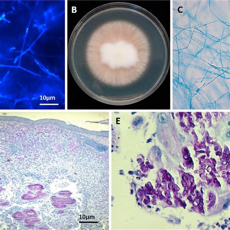 A Direct Microscopy Of Lesions Revealed Septate Branched Hyphae