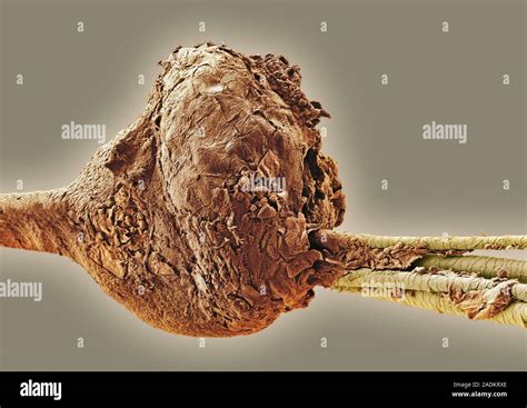 Blackhead Coloured Scanning Electron Micrograph Sem Of Hairs
