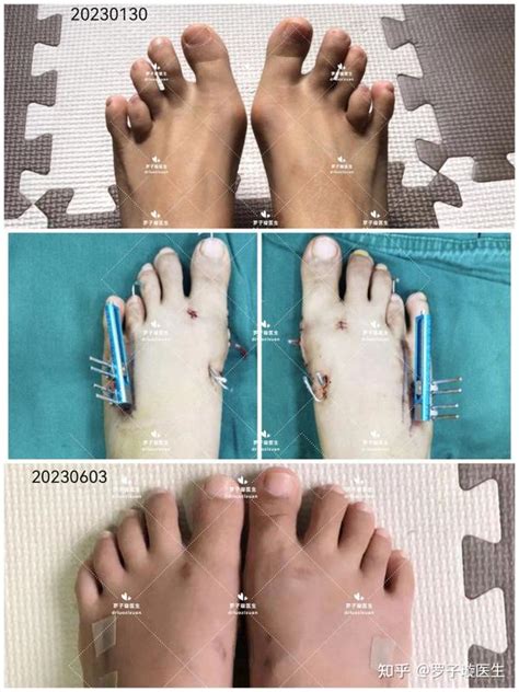 各种类型短趾症（脚趾短小症）术前术后对比。持续更新中，20240513 知乎