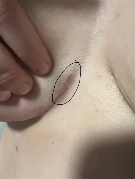 Infection Spitting Stitch Rreduction