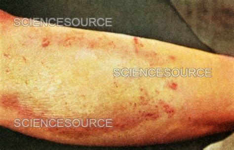 Lichen Simplex Chronicus