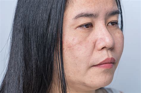 아시아 성인 여성의 얼굴에는 주근깨 큰 모공 여드름 및 흉터 문제가 오랫동안 돌보지 않아도됩니다 피부 문제는 고립 된 흰색