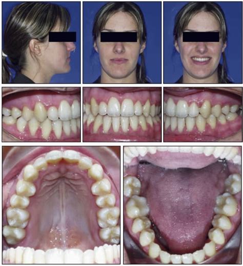Meaw Therapy Orthodontic Products Meaw Therapy Orthodontic Products