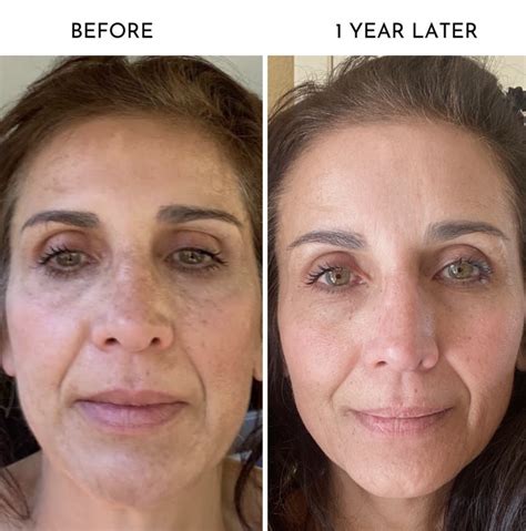 Antes y después del microneedling Consejos para la transformación