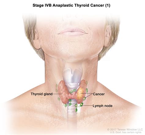 Thyroid Cancer Treatment Pdq Patient Version Nci