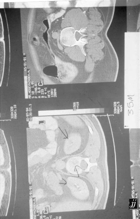 Spine Hydatid Left Psoas Muscle Radioogle