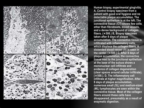 Clinical Features And Stages Of Gingivitis Pptx