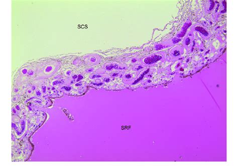 B This Image Shows The Detached Choroid With Diffuse Proliferation Of