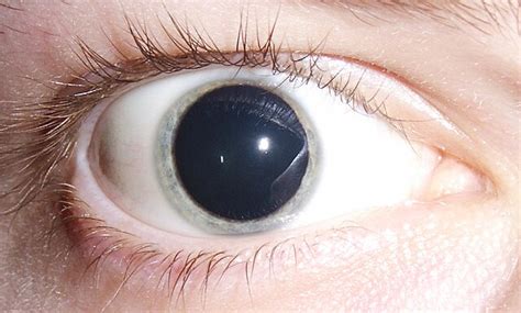 Pupils Dilated When High