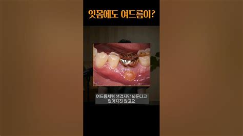 잇몸에 여드름이 치아 뿌리 끝에 염증 Youtube