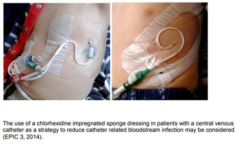 Groshong Catheter Vs Picc Line