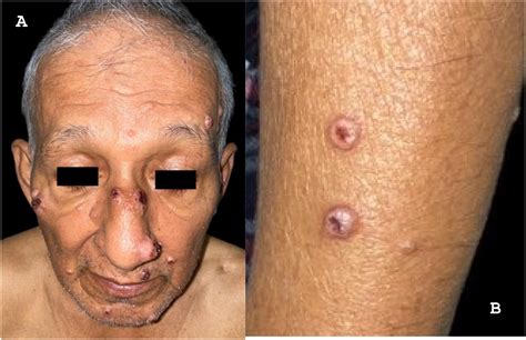 Criptococosis Cutánea Y Meningoencefálica En Un Paciente Adulto Mayor