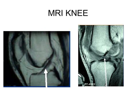 Arthroscopic Acl Reconstruction By Dr Shekhar Shrivastav