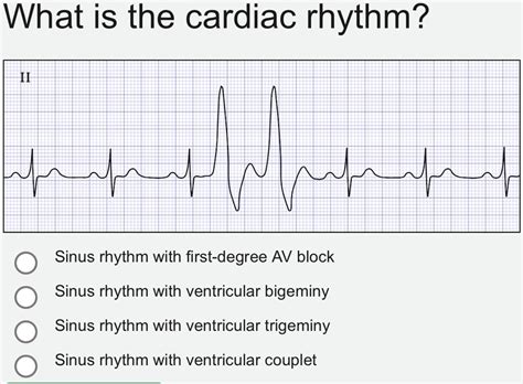 What Is The Cardiac Rhythm Shown In The Ekg Strip Choose From The