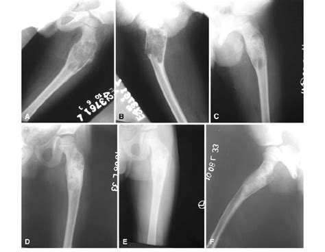 Af A Ap And B Lateral Radiographs Show An Abc Affecting The