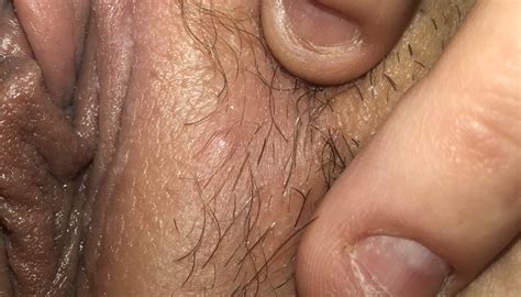 Cyst Or Pimple Or Something Else Sexual Health Forums