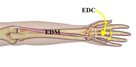 Extensor Digiti Minimi Edm Anatomy Anatomic Structures At Risk