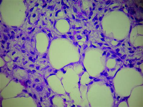 Microscopical Aspect Of The Tumor Oval And Spindle Cells Are Embedded