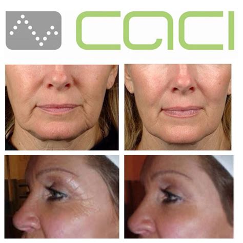 Before And After Pictures Of Caci Beauty And Health Microcurrent