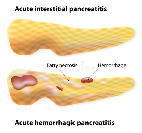 Interstitial Pancreatitis Stock Illustrations 5 Interstitial